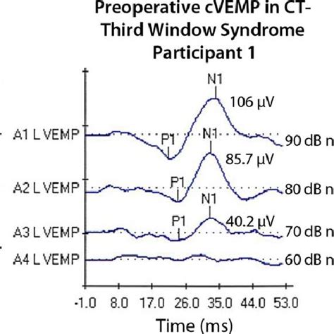 Preoperative Cervical Vestibular Evoked Potential CVEMP Responses In Download Scientific