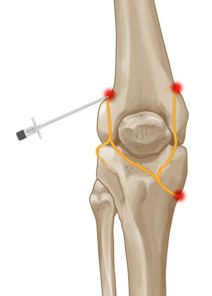 Genicular Nerve Block And Radiofrequency Ablation Gnrfa Appalachian