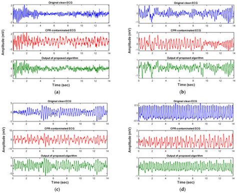 Sensors Special Issue Novel Wearable Ecg Sensors And Signal