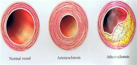 Arterisclerosis Flashcards Quizlet