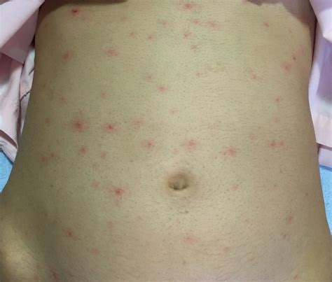 Picture Of The Patients Skin Upon Admission The Rash Includes