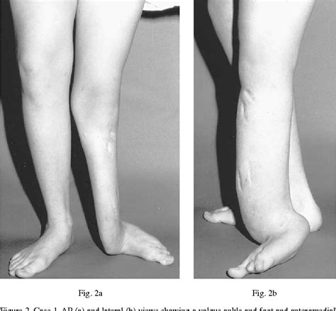 Fibular Hemimelia Limb Lengthening