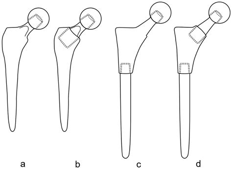 Encyclopedia Free Full Text Dual Modular Stems For Primary Total Hip Arthroplasty