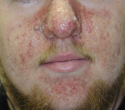 Tuberous Sclerosis School Of Medicine