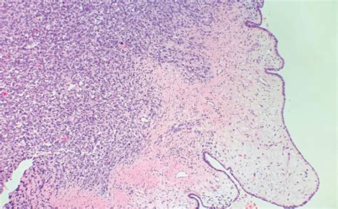 Malignant Phyllodes Tumor A B The Characteristic Leaf Like Download Scientific Diagram