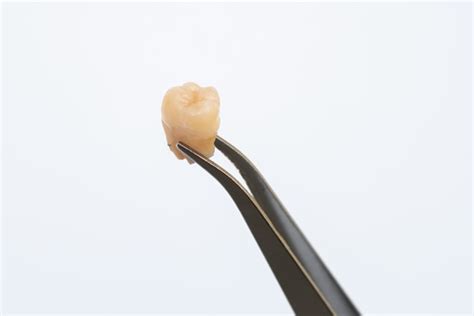 When Is Wisdom Tooth Extraction Necessary Smiles Dental Care