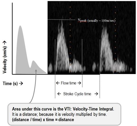 Lvot Doppler For Estimation Of Cardiac Output Deranged Physiology