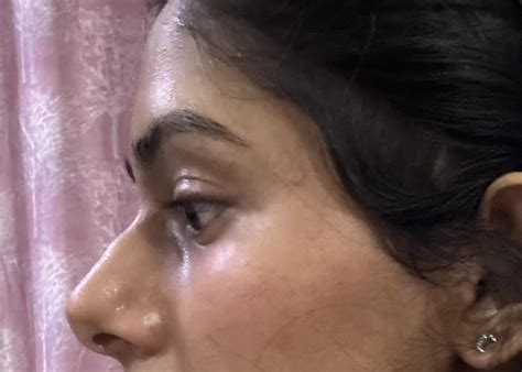 Hyperpigmentation Inbetween Nose And Eye Corners Rskinwhitening
