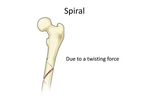 Fracture Coding Cm And Pcs Pptx Death Injury Or Military Conflict Fracture Coding Cm And Pcs Pptx Death Injury Or Military Conflict