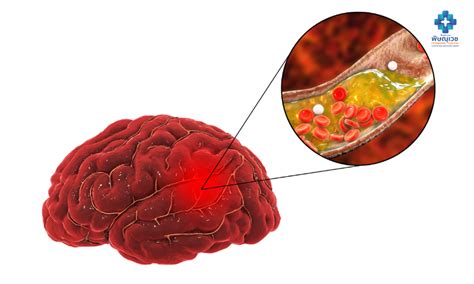 โรคหลอดเลือดสมอง Stroke