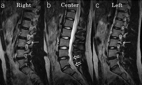 Spondylolysis Mri
