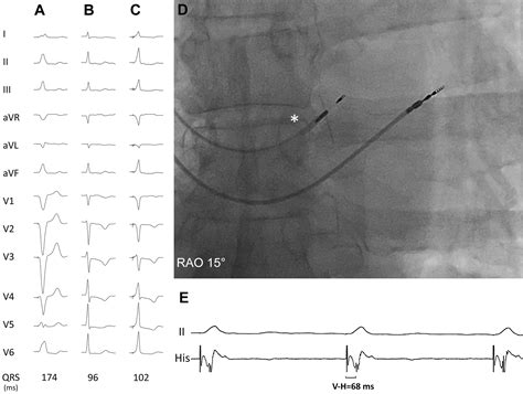 His Bundle Electrogram