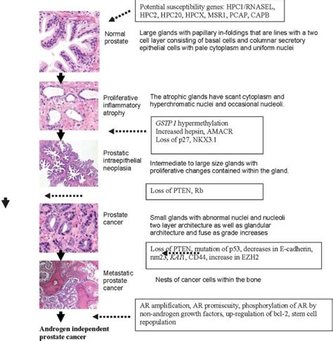 Prostate Cancer Histology