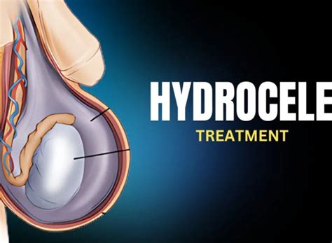 Hydrocele Lowcost Surgicals