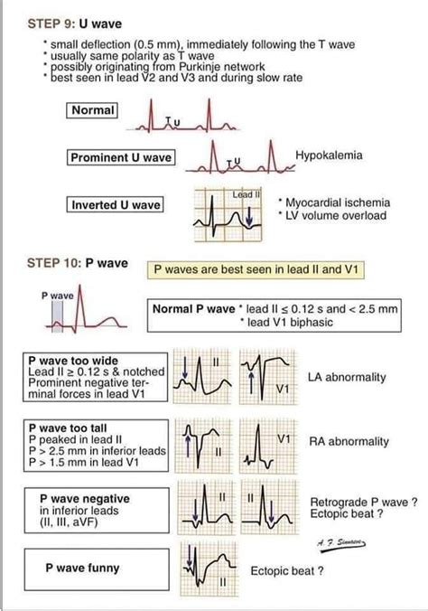 Ecg Interpretation Characteristics Of The Normal Ecg P Wave Qrs Complex