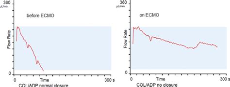 Primary Haemostasis Evaluated By A Pfa 200 Coladp Before Ecmo