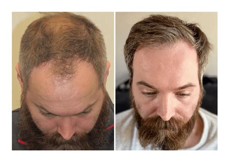 Hair Transplant Beforeafter Results For Men Bosley Hair Transplant