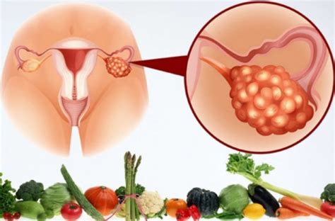 Синдром на поликистозни яйчници диетични насоки — Medconsult Bg