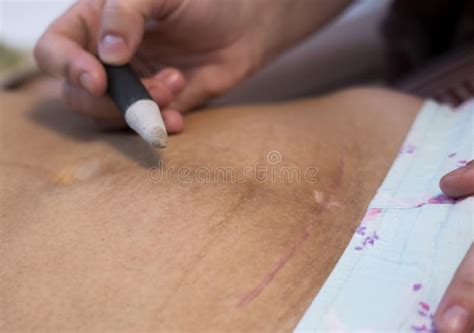 Moxibustion Procedure At Health Centers Alternative Medicine Therapist