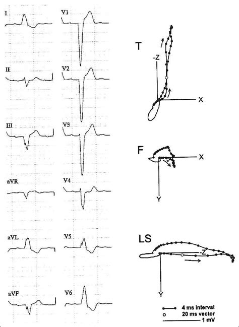 A 12 Lead Ecg And Derived Vectorcardiogram Vcg Demonstrating Left