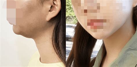 파워v지방흡입v라인전체코르셋이중턱근육묶기 닥터정리반 닥터정 리반의원 파워v지방흡입v라인전체코르셋이중턱근육묶기 닥터정리반 닥터정 리반의원
