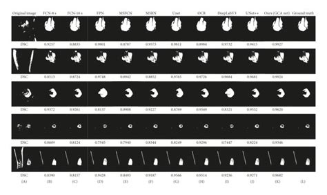 The Segmentation Effects Of Models On Some Osteosarcoma Mri Images Download Scientific Diagram