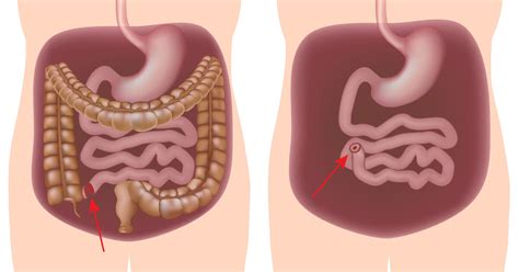 Minimally Invasive Surgical May Protect Postoperative Bowel Dysfunction After Restorative