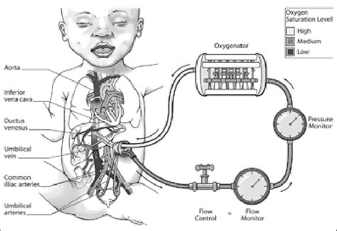 Newborn With Artificial Placental Support Download Scientific Diagram