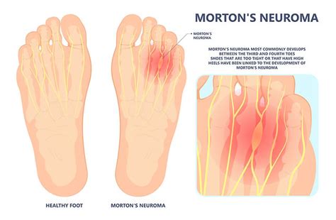 Mortons Neuroma Cortisone Injection Musculoskeletal Ultrasound And Injections