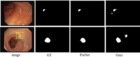 Imperfect Segmentation Analysis Versus Pranet Download Scientific Diagram