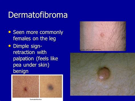 Primary Care Derm Ppt Video Online Download