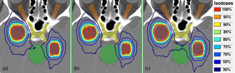 Axial Ct Slice With Isodose Lines Superimposed Corresponding To A Download Scientific