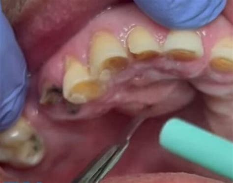 Dental Abscess Drainage Aftercare Archives New Pimple Popping Videos