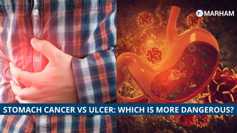 Stomach Cancer Vs Ulcer Similarities And Differences Marham