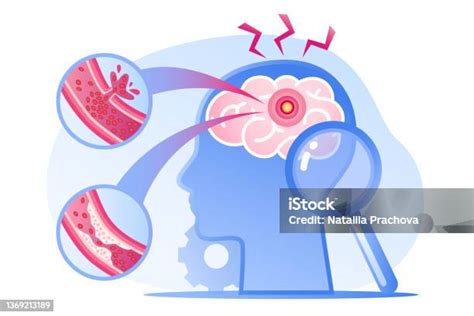 뇌 뇌졸중 질환 죽상 동맥 경화증 출혈 및 통증 포인트를 가진 인간의 머리 벡터 플랫 인포그래픽 의료 개념 일러스트레이션