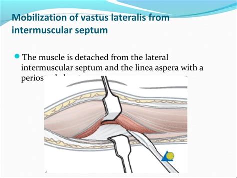 Teknik Operasi Orif Femur Ppt