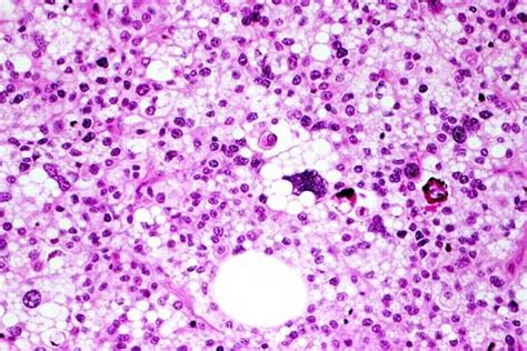 Soft Tissue Sarcoma Pathology Orthobullets