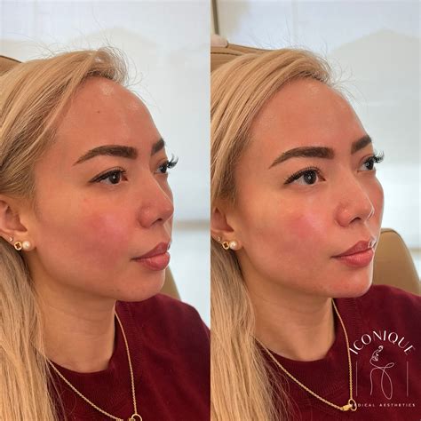 Iconique Aesthetics Lower Face Contouring 💉📐 We Used A Combination Of