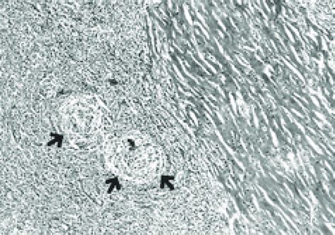 Microscopic Findings Show Marked Lymphoid Proliferation With Distinct