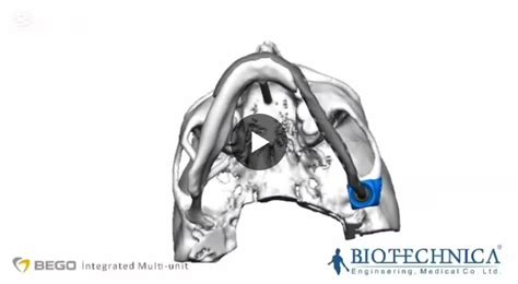 Custom Made Tmj Prosthesis Temporomandibular Joint Prosthesis A