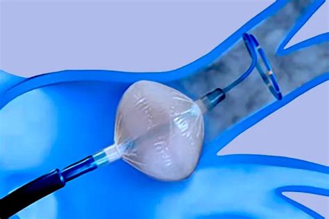 3d Ablation And Mapping Prof Dr Taylan Akgün