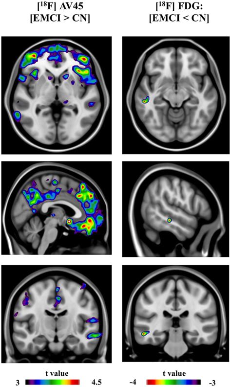 Images Represent Statistical Parametric Mapping Depicting Spectrum