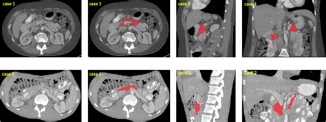 Figure 1 From Cascaded Multitask 3 D Fully Convolutional Networks For