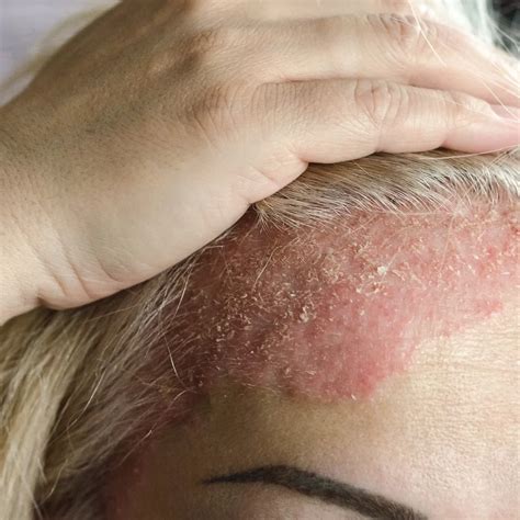 Seborrheic Dermatitis Medical Clinic St Albans
