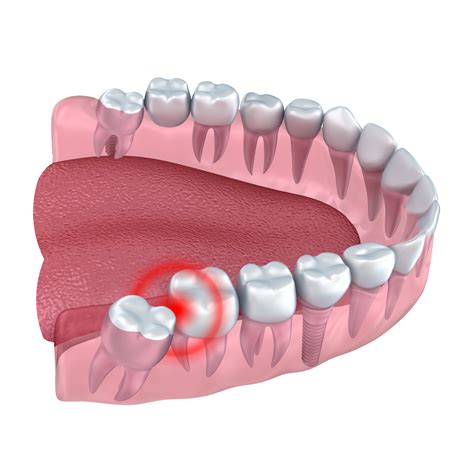 Wisdom Teeth Removal Cardinia Dental