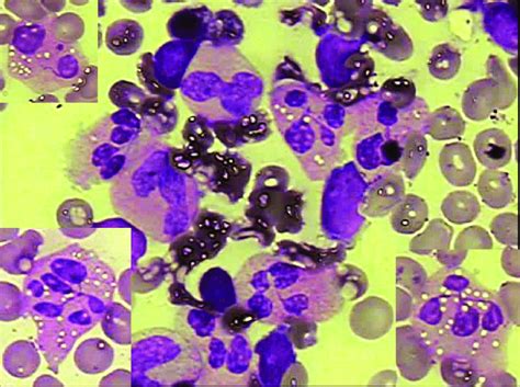 Morphological Abnormalities Of Mature Neutrophils On Leishman Stained