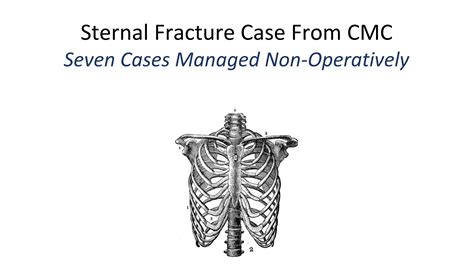 Sternal Fractures And Dislocations Emguidewire Radiology Reading Room