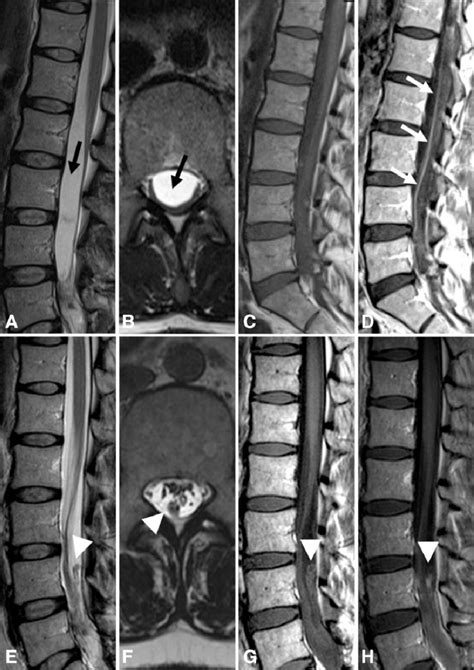 Lumbar Spine Magnetic Resonance Imaging Mri Findings A B Mri Of Download Scientific