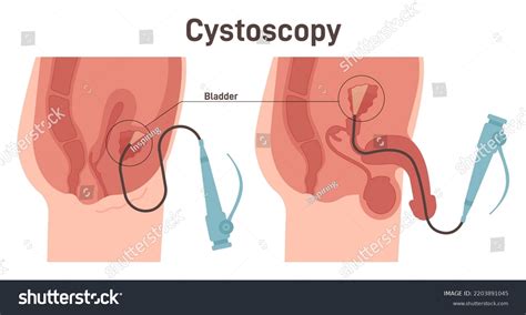 Cystoscopy Set Male Female Bladder Surface Stock Vector Royalty Free 2203891045 Shutterstock