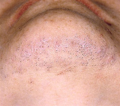 Long Term Effects Of Laser Hair Removal Cheap Sale